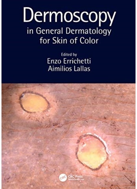 Dermoscopy in General Dermatology for Skin of Color | Pegasas